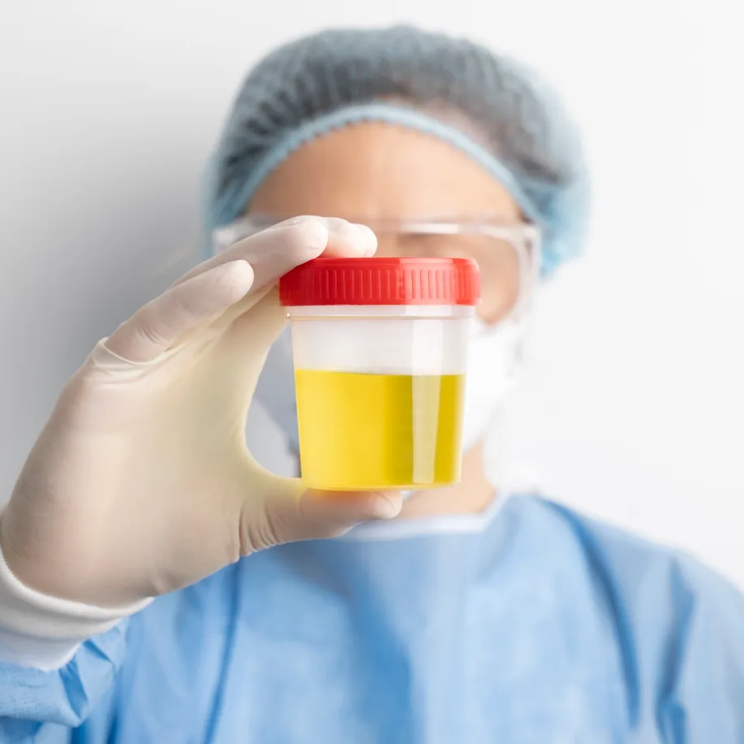 Urine ACR (Albumin-Creatinine Ratio) test Online in Dhaka | Arogga ...