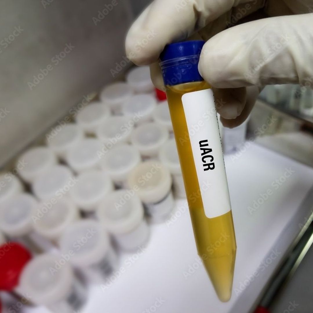 Urine Albumin Creatinine Ratio (ACR) - Arogga Online Lab